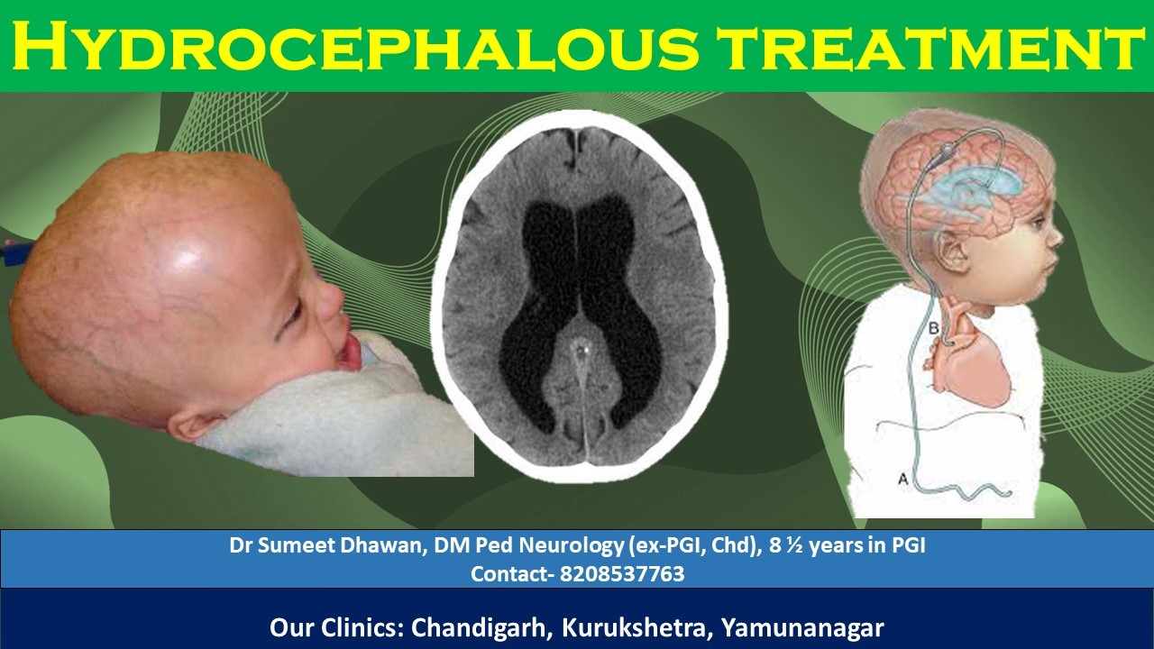 Hydrocephalous treatment in Children and Adult - Dr Sumeet Dhawan ...
